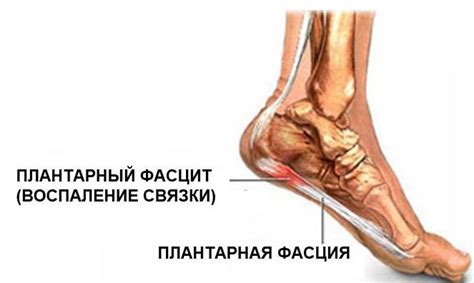 Лечение пяточной шпоры лазером: отзывы, курс лечения и противопоказания