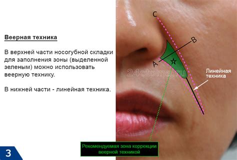 Как убрать носогубные складки – отзывы, филлеры в носогубки, видео