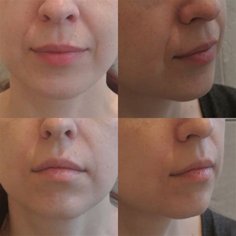 Носогубные складки — vzbeauty.ru